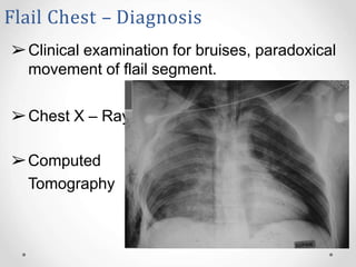flailchest-140501045412-phpapp01.pptx