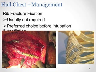 flailchest-140501045412-phpapp01.pptx