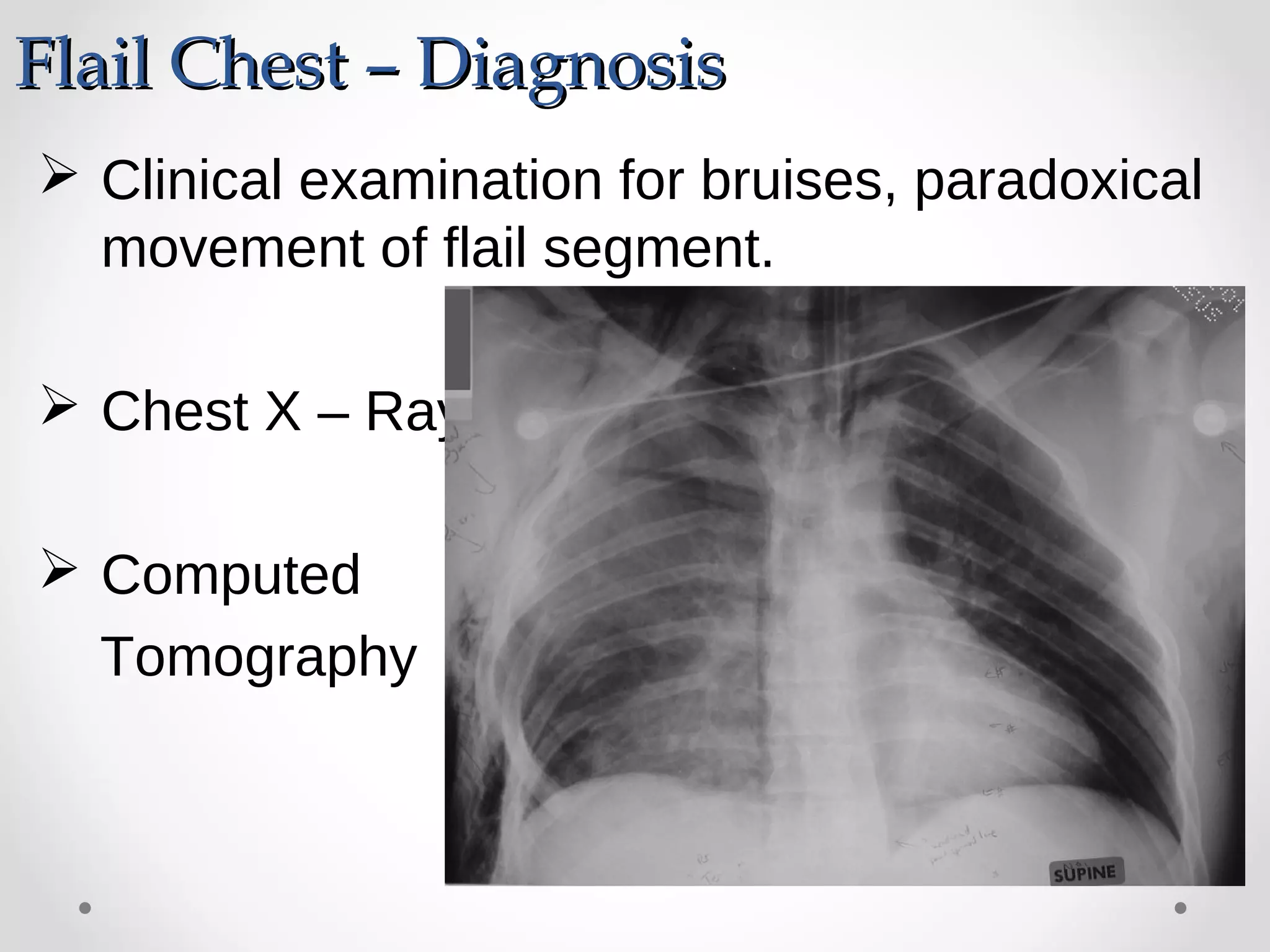 Flail chest | PPT