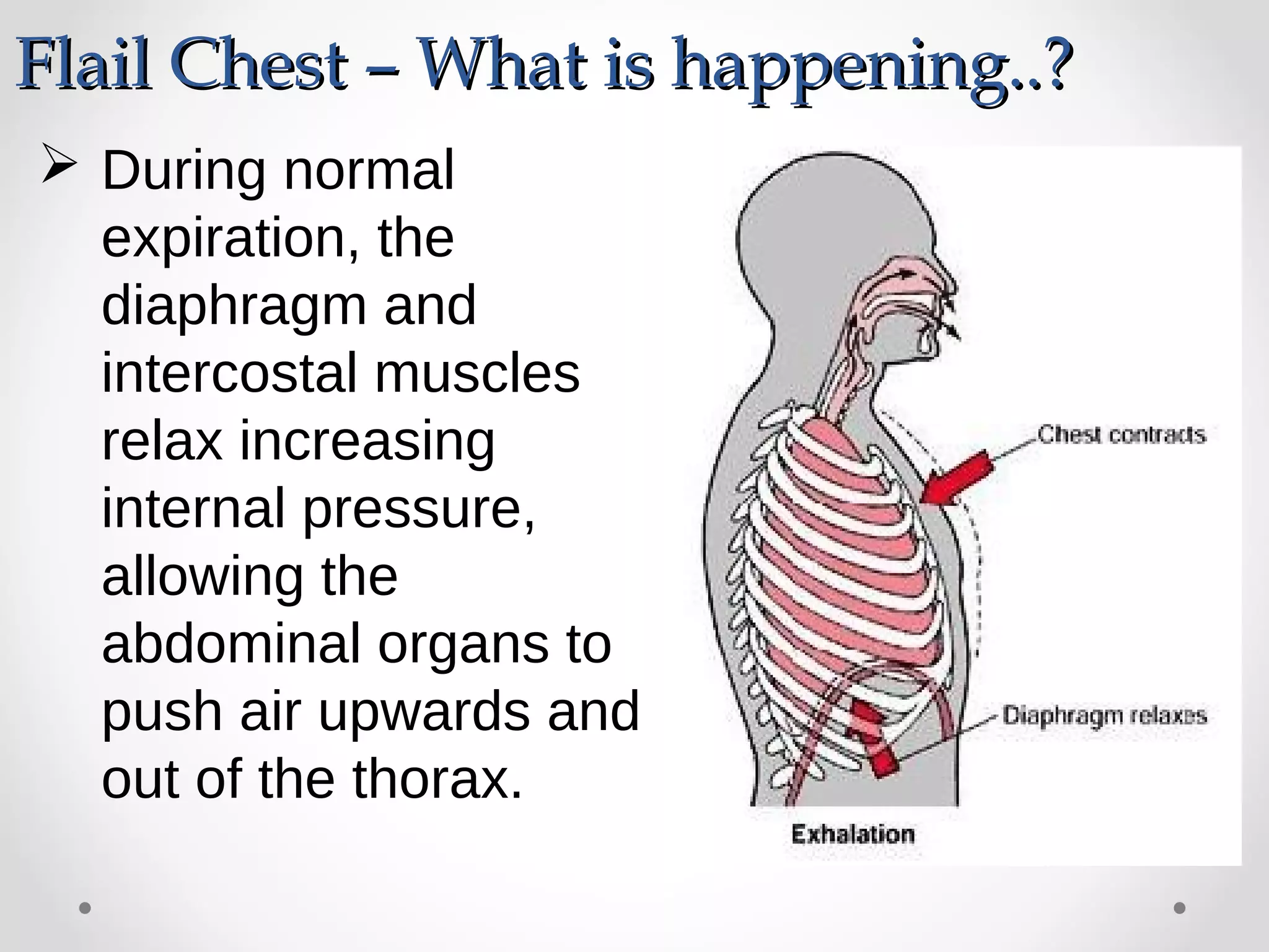 Flail chest | PPT