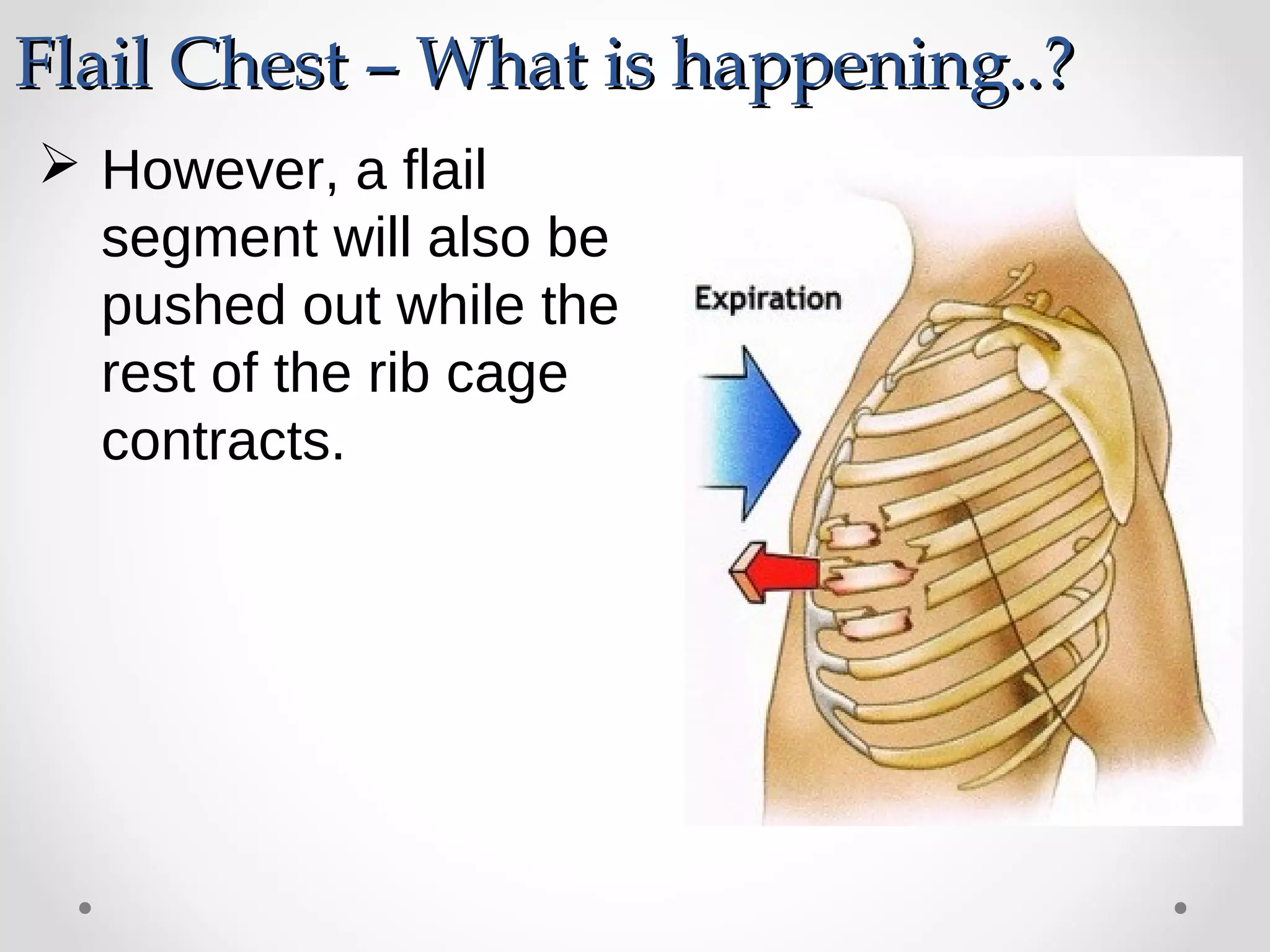 Flail chest | PPT