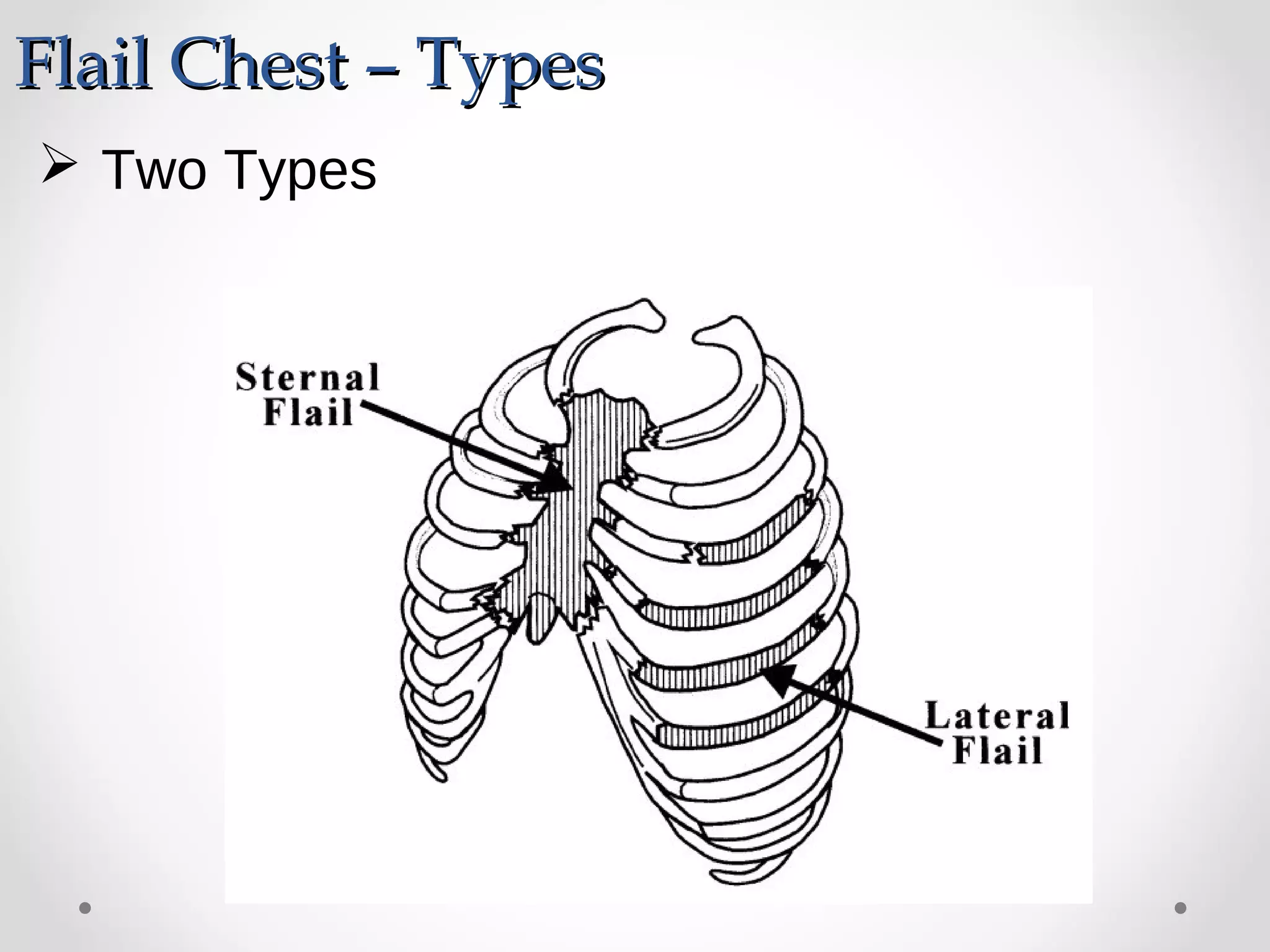 Flail chest | PPT