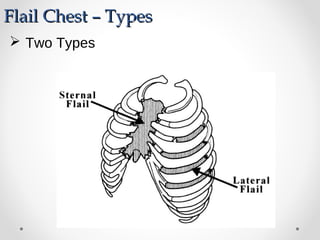 Flail chest | PPT