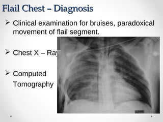 Flail Chest X Ray