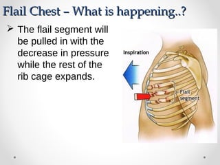 Flail Chest Diagram