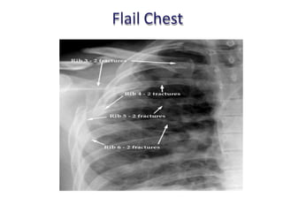 Flail chest | PPTX