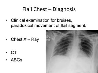 Flail chest | PPTX