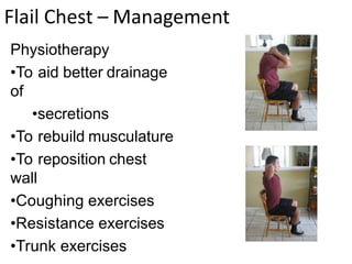 Flail chest | PPTX