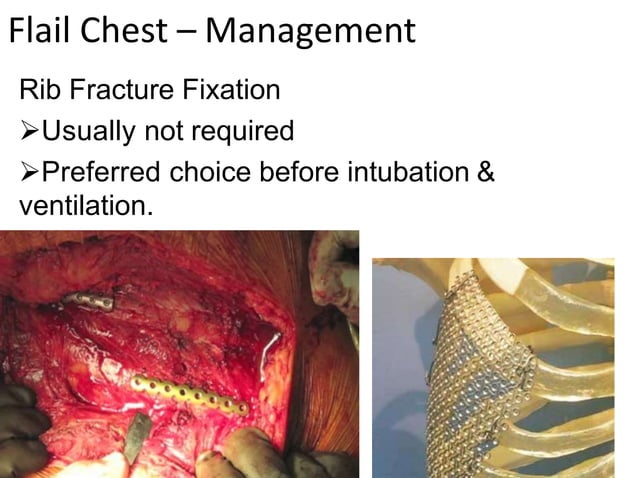 Flail chest | PPT