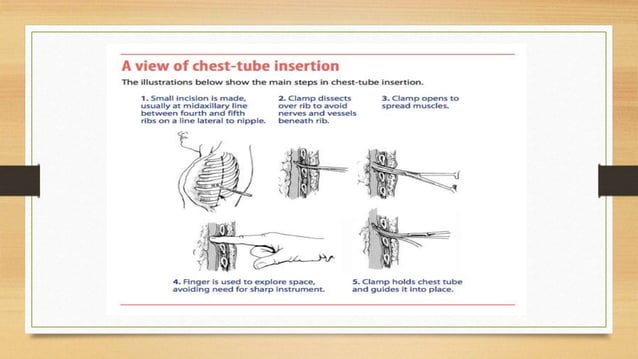 Flail chest | PPTX