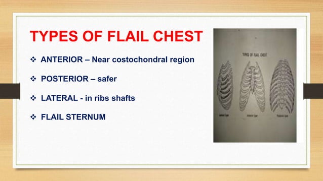 Flail chest | PPTX