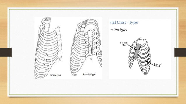 Flail chest | PPTX