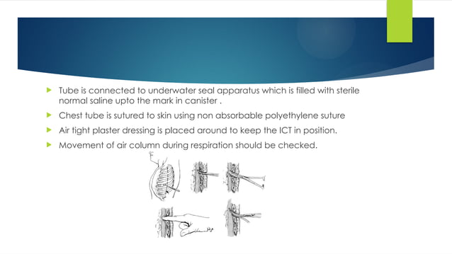 FLAIL CHEST.pptx surgery trauma , thoracic injury | PPT