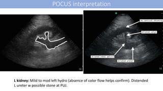 Flank pain and fever | PPTX