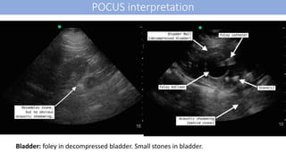 Flank pain and fever | PPTX