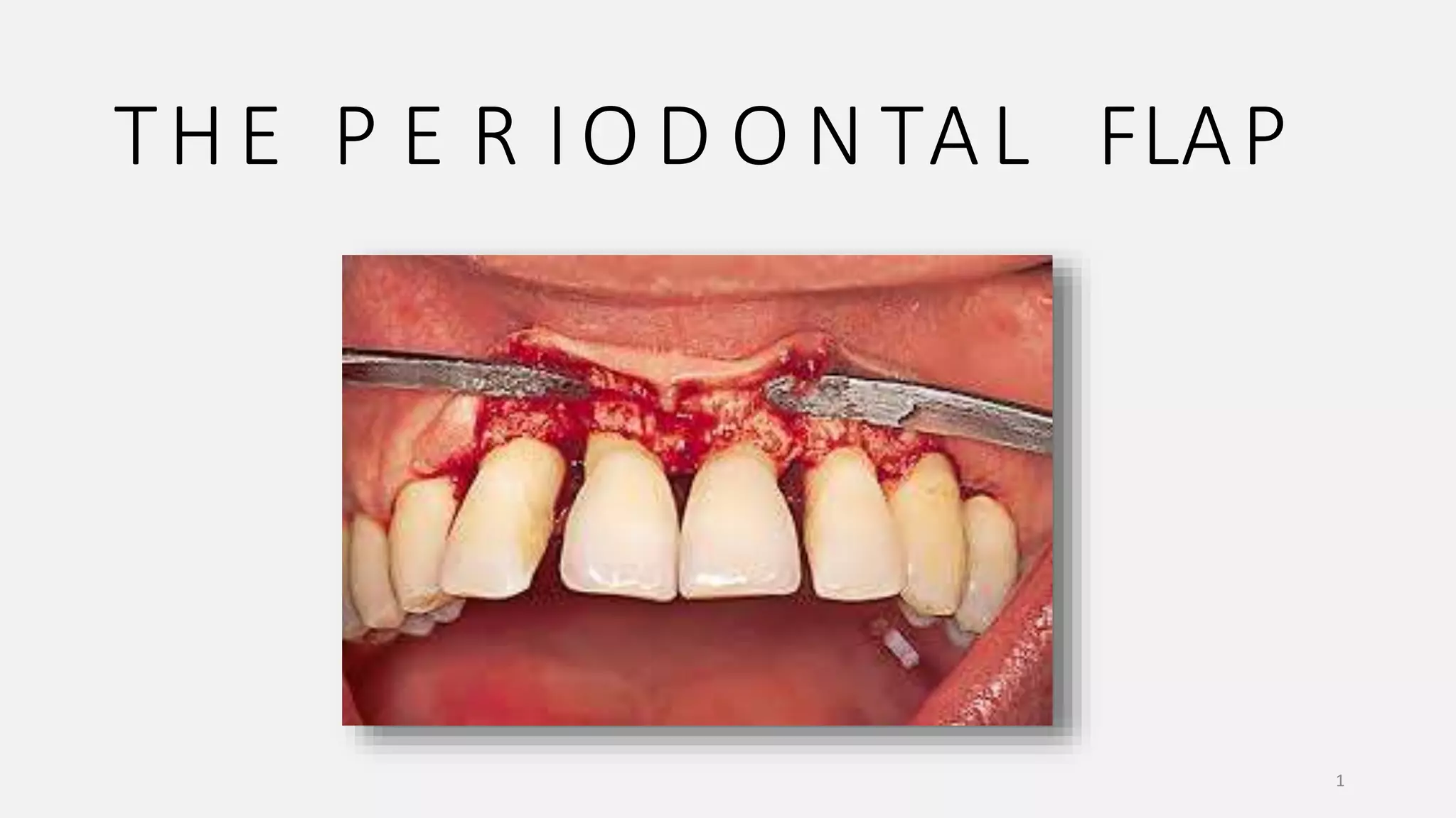 periodontal flap | PPTX