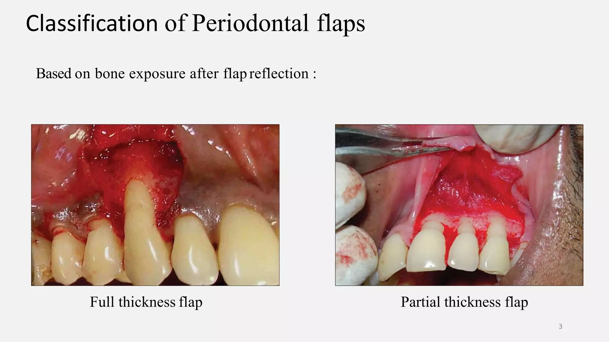 periodontal flap | PPT