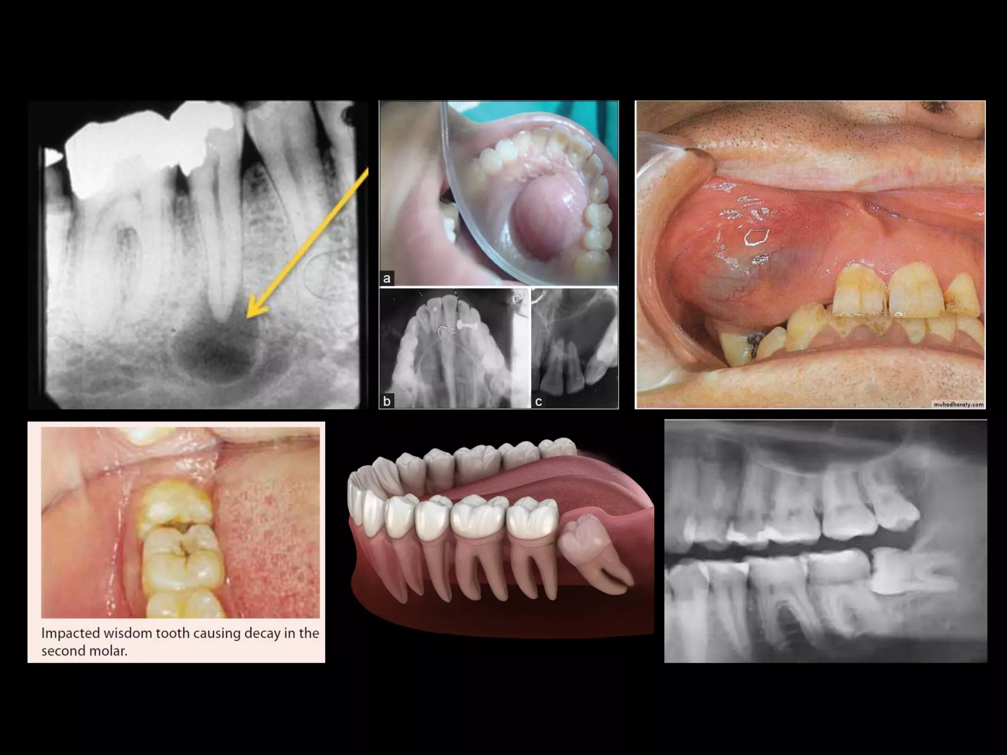 Flap Design for Minor Oral Surgery | PDF