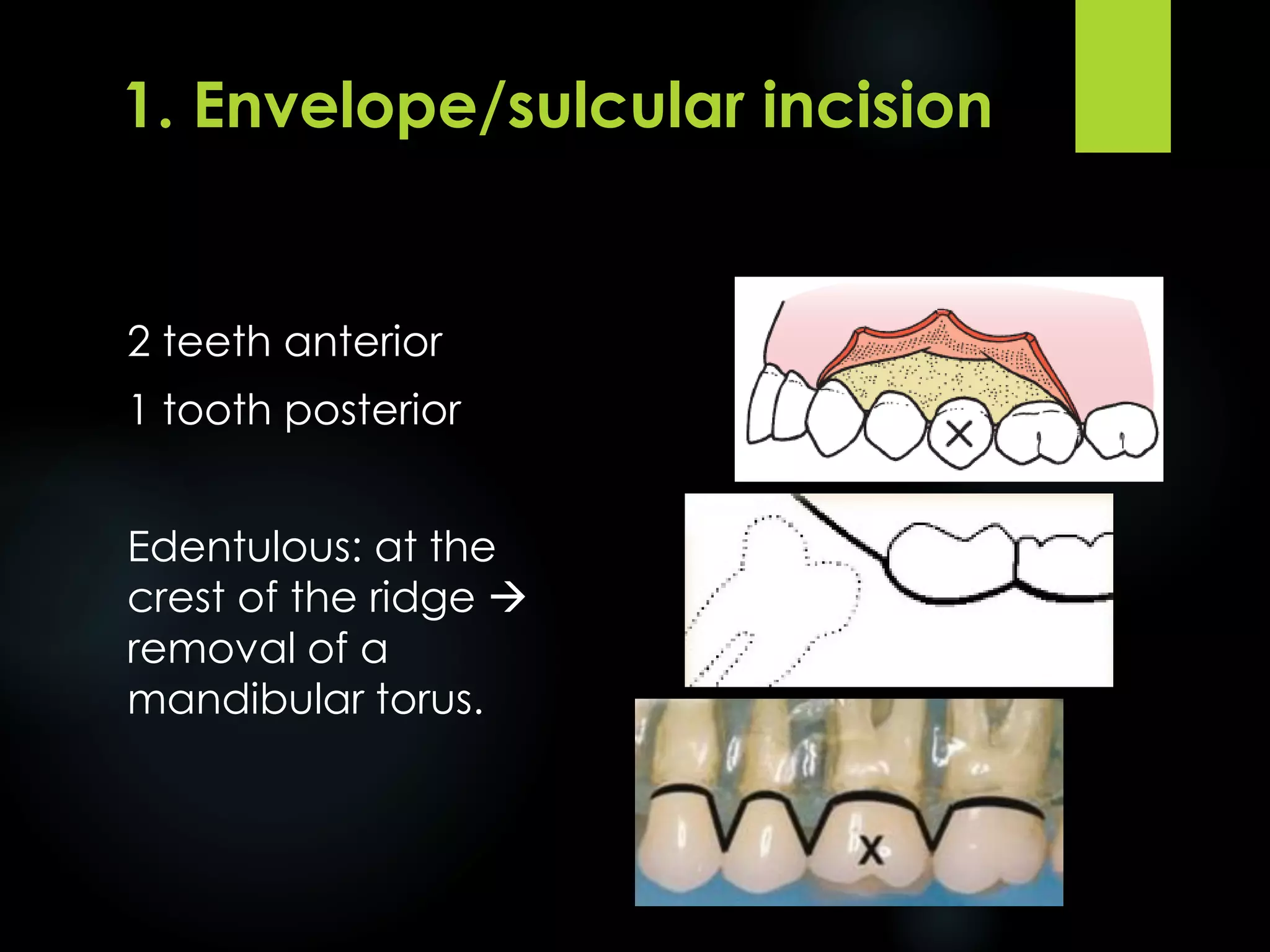 Flap Design for Minor Oral Surgery | PDF