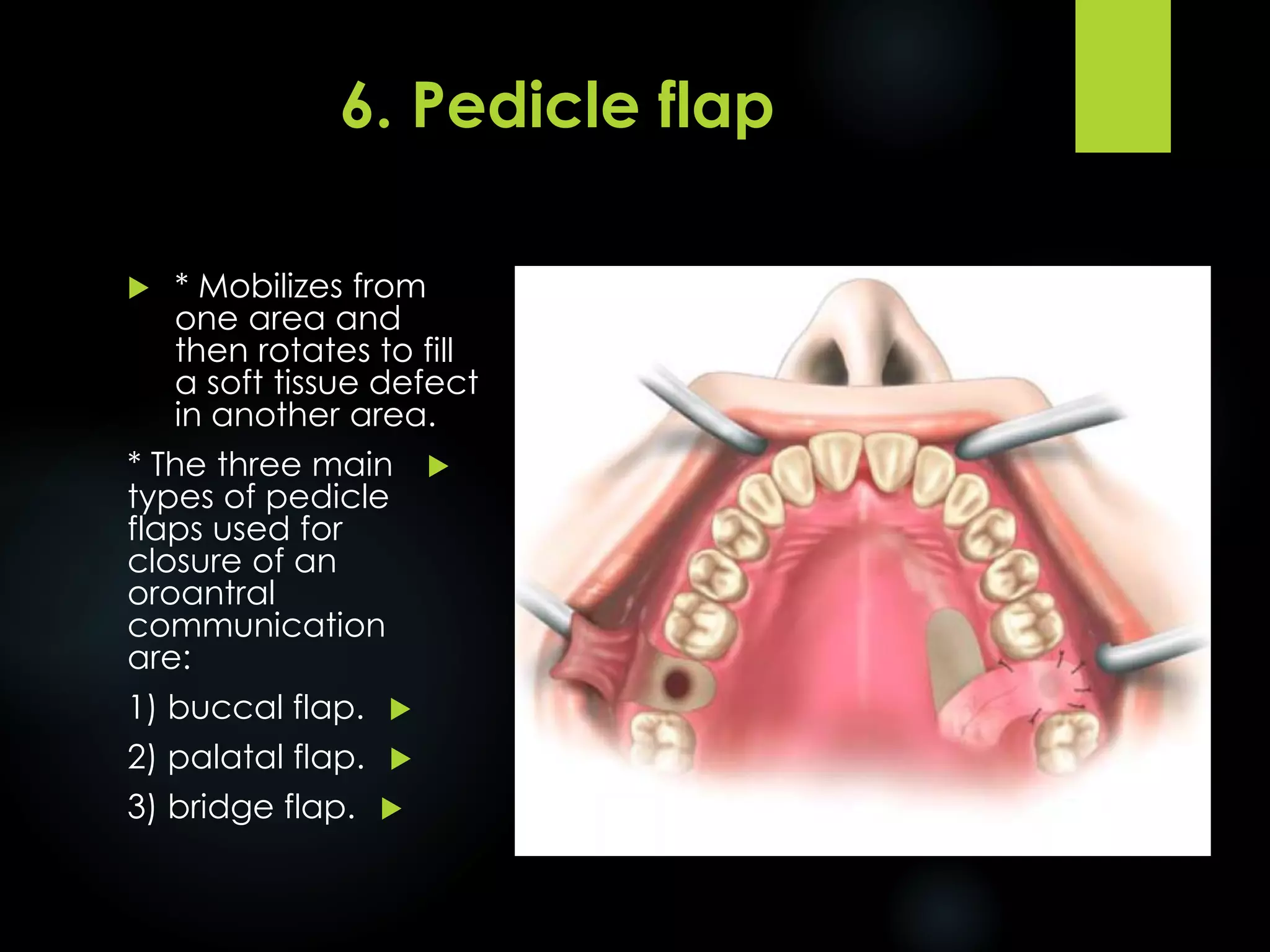 Flap Design for Minor Oral Surgery | PDF