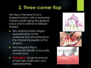 Flap Design for Minor Oral Surgery | PDF