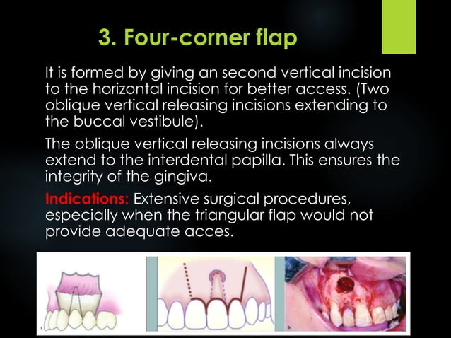Flap Design for Minor Oral Surgery | PDF | Dental Health | Diseases and ...