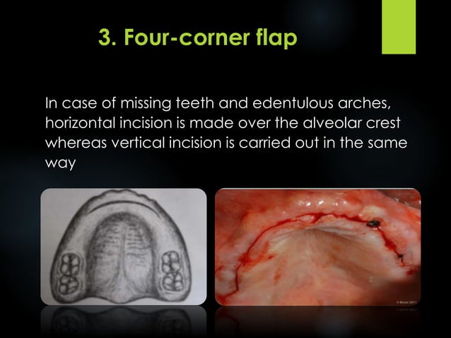 Flap Design for Minor Oral Surgery | PDF | Dental Health | Diseases and ...