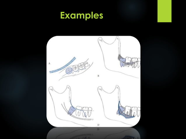 Flap Design for Minor Oral Surgery | PDF | Dental Health | Diseases and ...