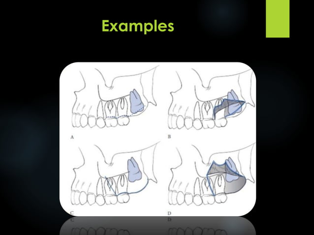 Flap Design for Minor Oral Surgery | PDF | Dental Health | Diseases and ...