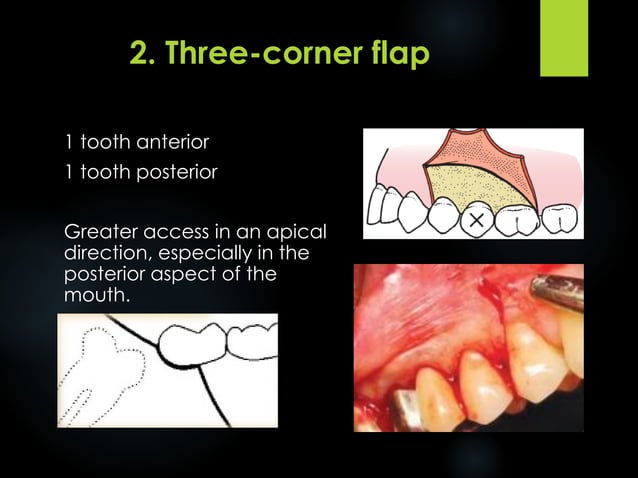 Flap Design for Minor Oral Surgery