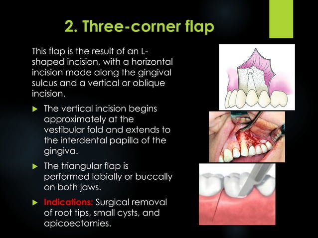 Flap Design for Minor Oral Surgery