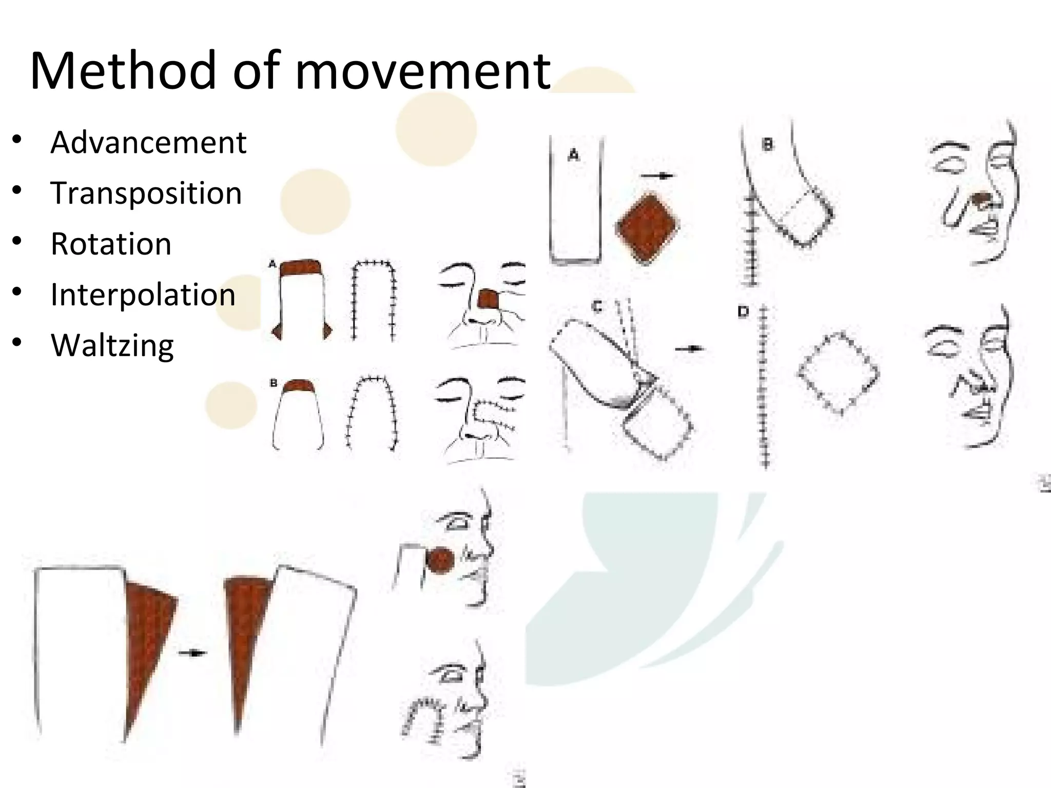 Flap classification | PPT