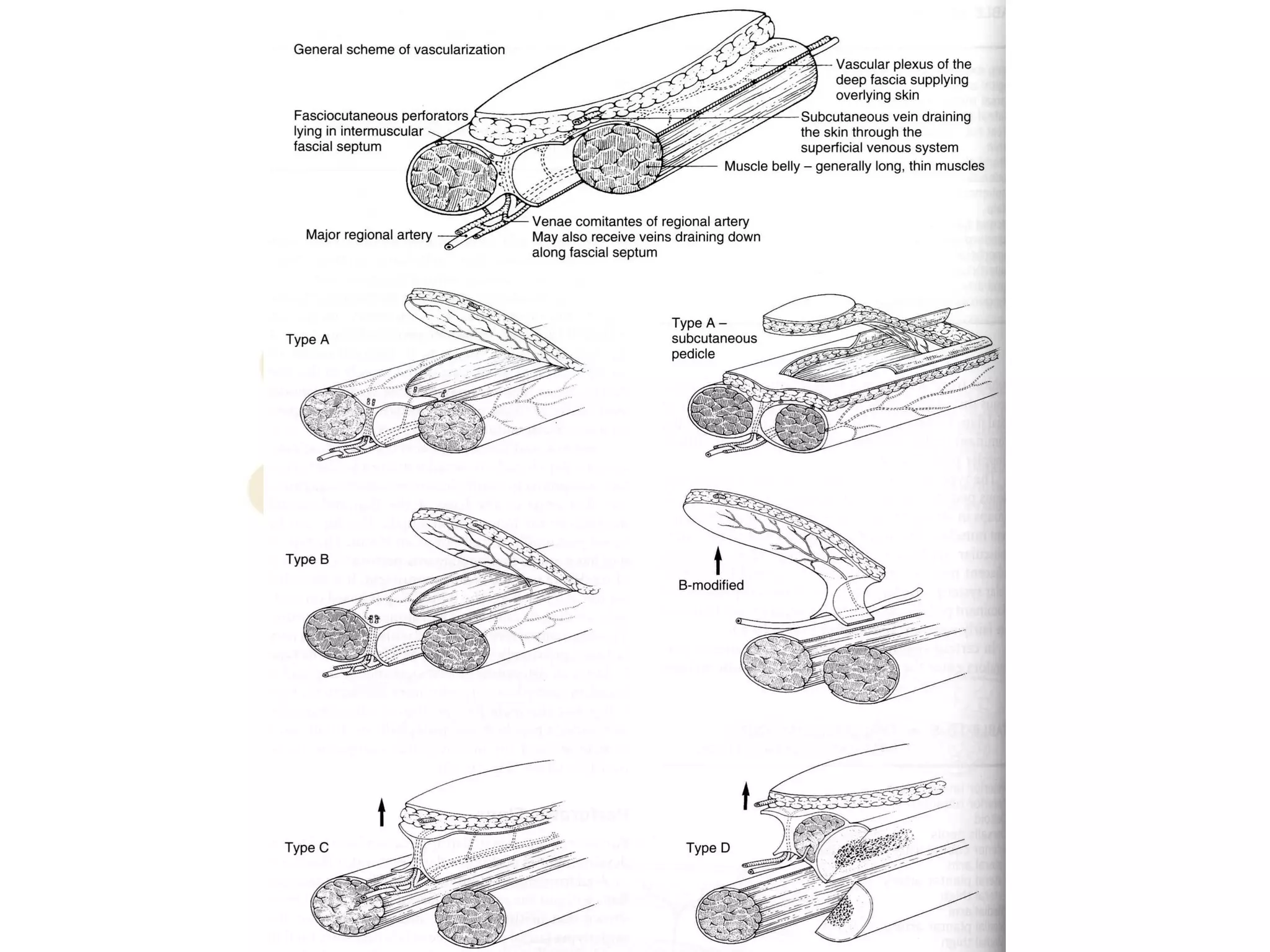 Flap classification | PPT