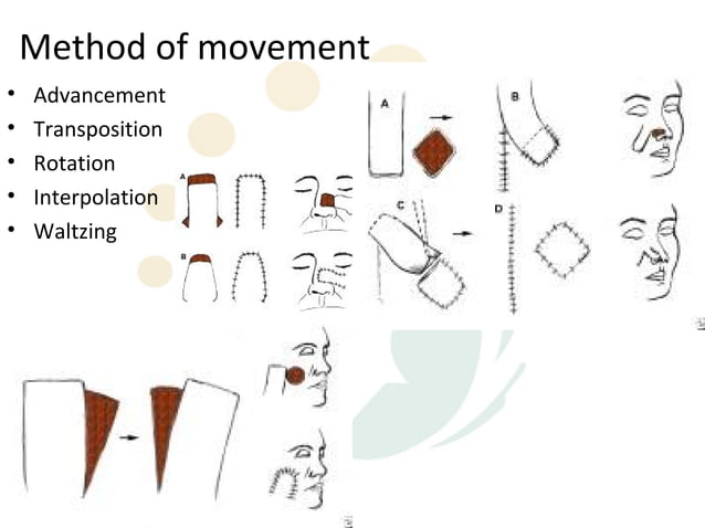 Flap classification | PPT