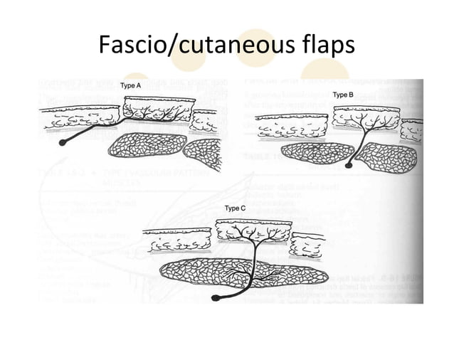 Flap classification | PPT