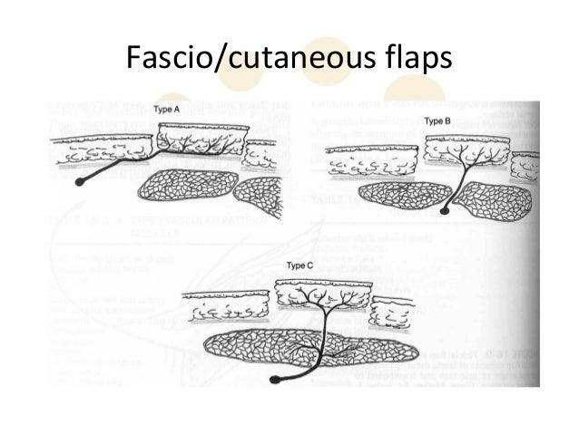 Flap classification