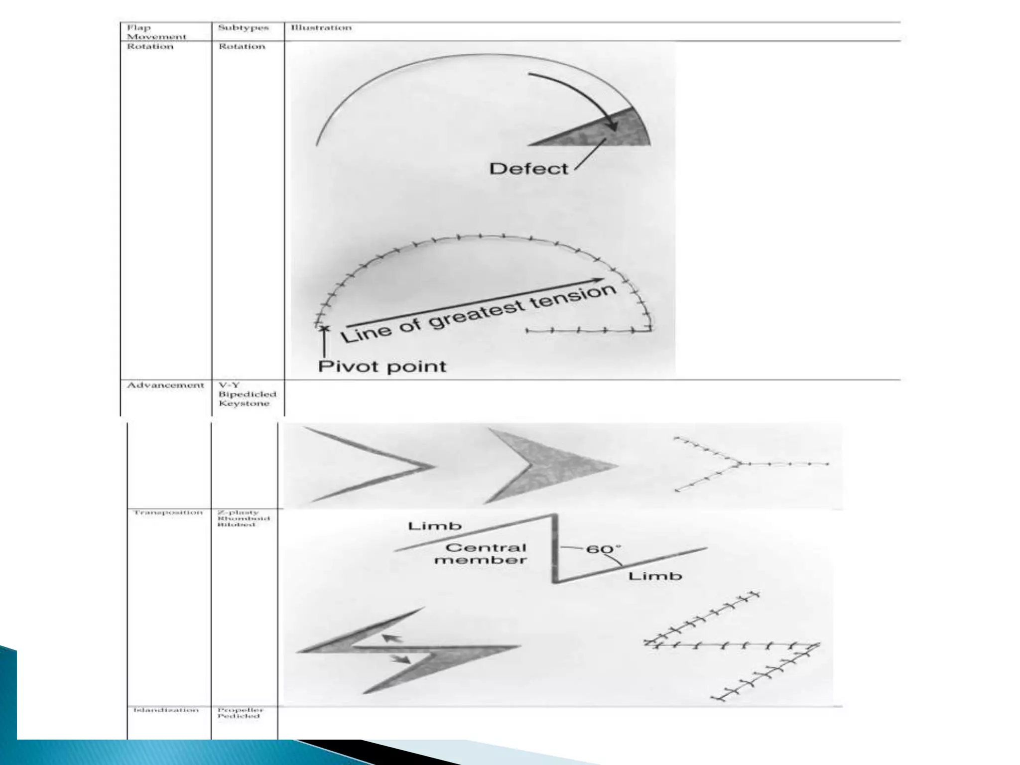 Flap and its classification | PPTX