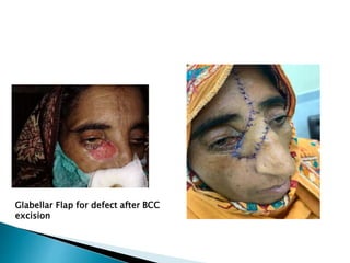 Flap and its classification | PPTX