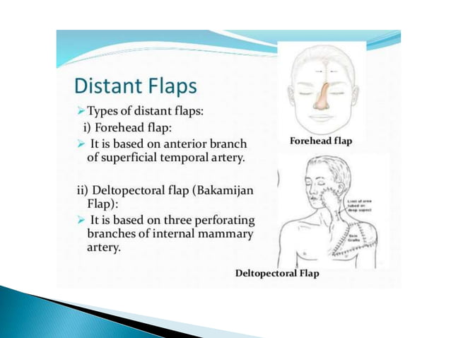 Flap and its classification | PPTX | Surgery | Medical Health