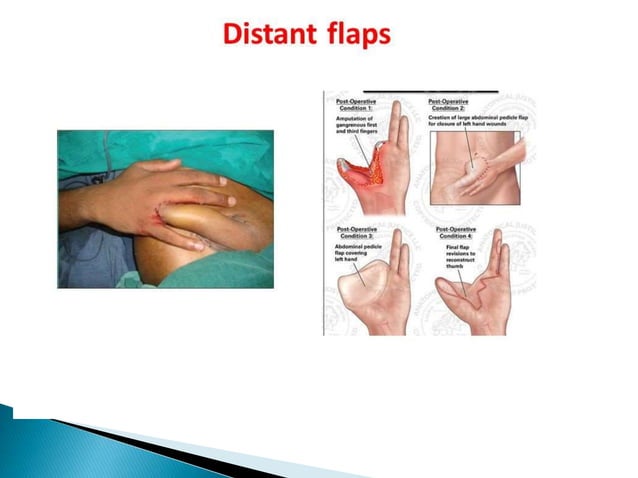 Flap and its classification | PPTX | Surgery | Medical Health