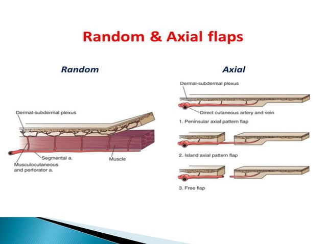 Flap and its classification | PPTX | Surgery | Medical Health