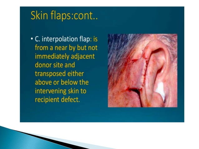 Flap and its classification | PPTX | Surgery | Medical Health