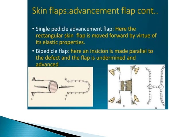 Flap and its classification | PPTX | Surgery | Medical Health