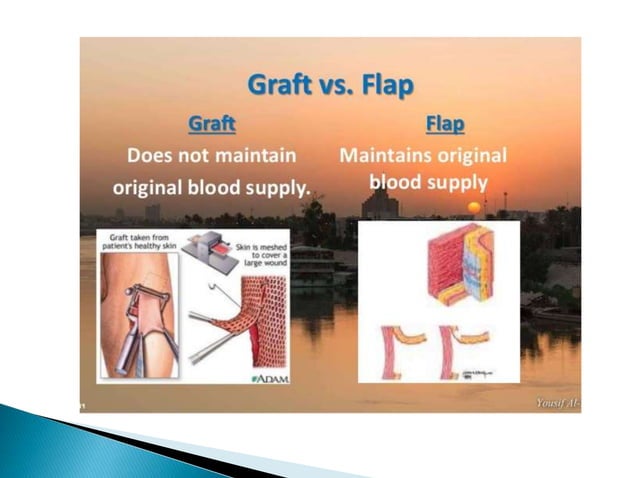 Flap and its classification | PPTX | Surgery | Medical Health