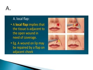 Flap and its classification | PPT