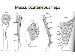 Flap classification | PPT