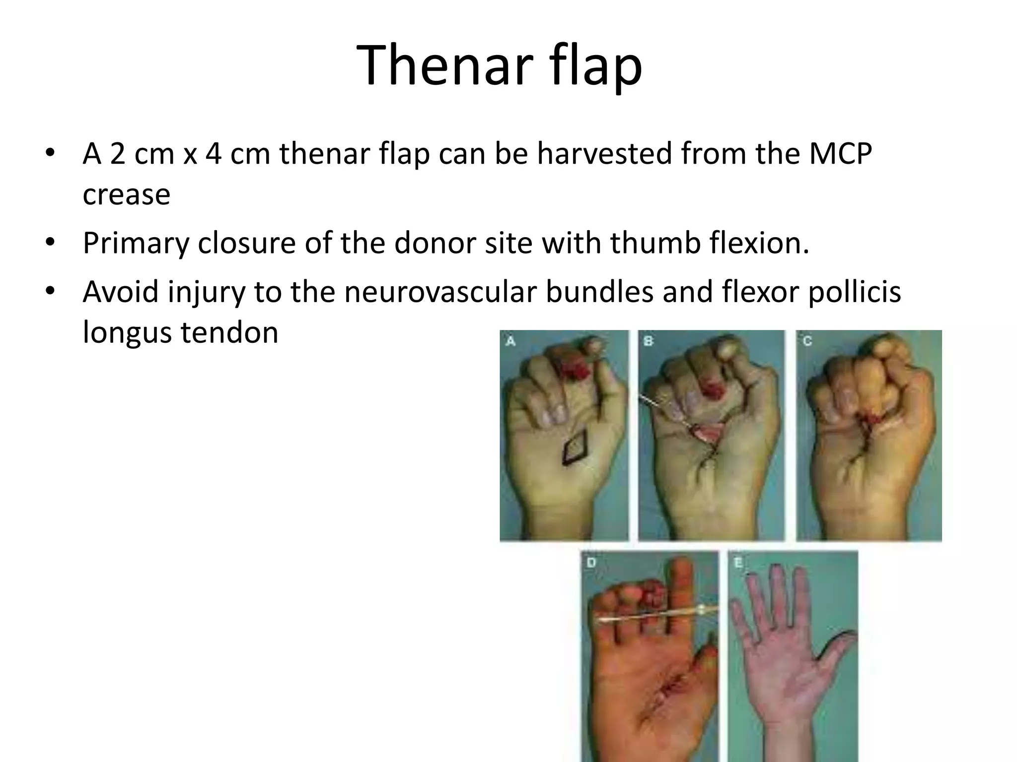 Flap coverage in upper extremities in trauma | PPTX