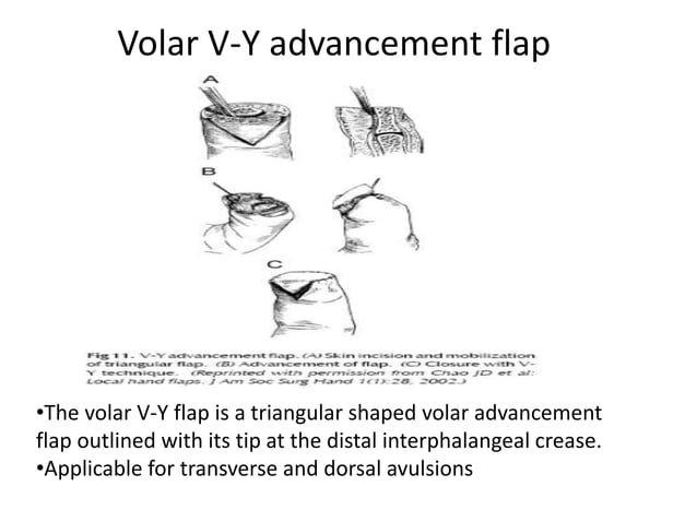 Flap coverage in upper extremities in trauma | PPTX