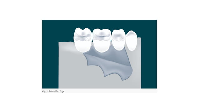 flap designs.pdf | Dental Health | Diseases and Conditions