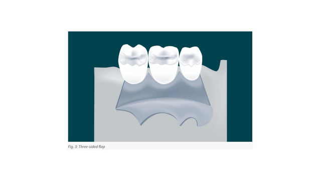 flap designs.pdf | Dental Health | Diseases and Conditions